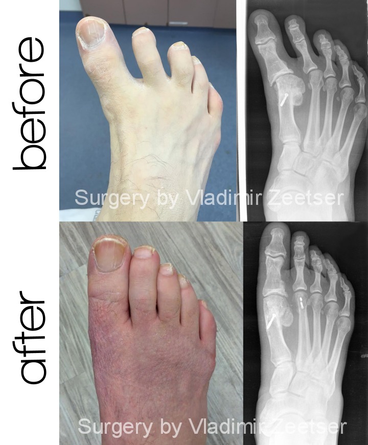 Best Podiatrist for Hallux Varus | FastForward Porcedure | Encino ...